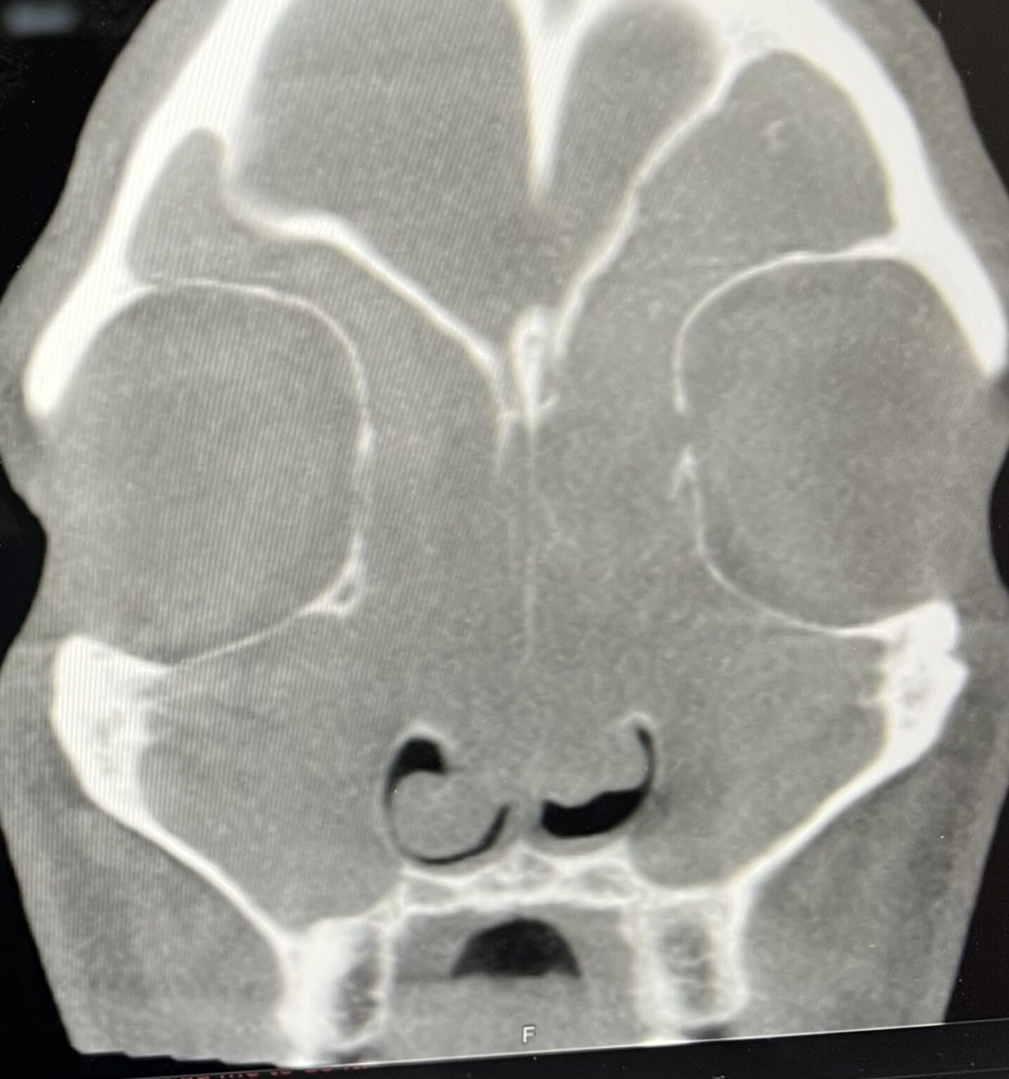Nasal Polyp Symptoms: What Are They? - AESC